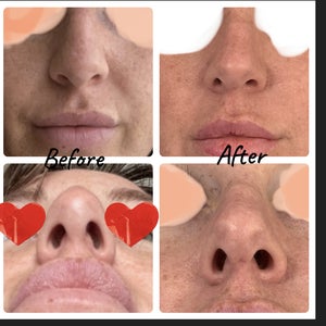 nose realignment nhs