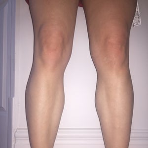 fat dissolving calves