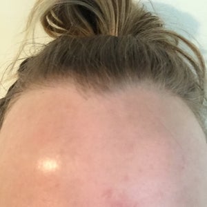 birthmark on forehead