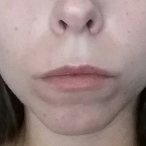 Swollen Skin Below Lower Lip Filler - Infoupdate.org