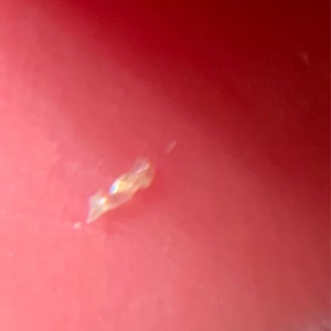 Sebum Plug Inside Nose