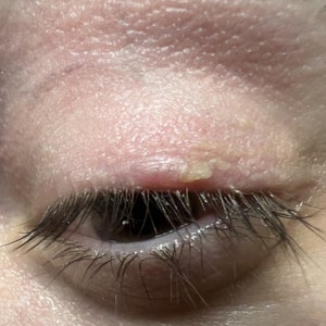 kenalog eye injection