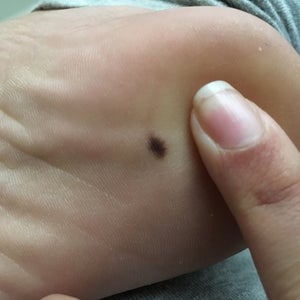 Melanoma Sole Of Foot