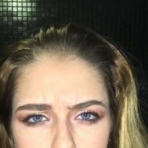 eczema forehead lines