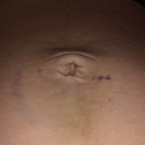 hernia surgery scared