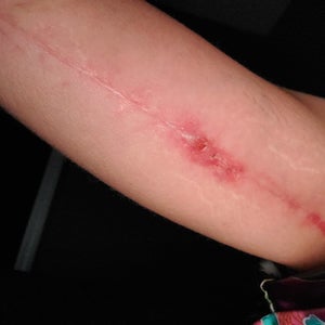 forearm surgery stitches