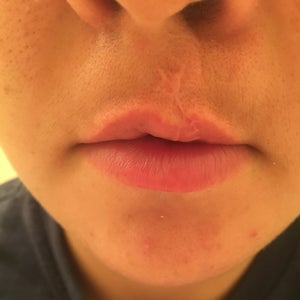 Cleft Lip Scar