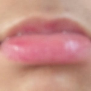 cockroach bites on lips