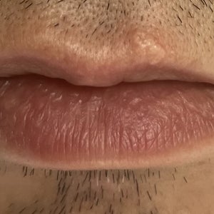 Why Get White Spots On Lips Reddit - Infoupdate.org