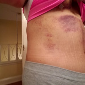 abdominal bruising