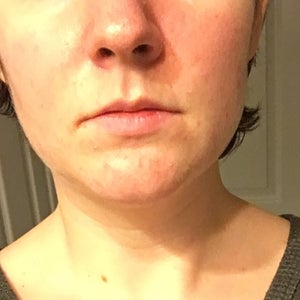 Stassi Schroeder Chin Implant