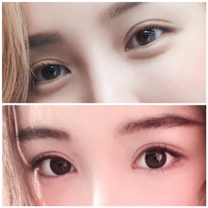 Is Asian eyelid surgery revision possible to obtain the parallel eyelid crease with my eyes photos