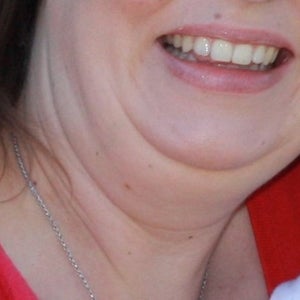 Bulimia Chipmunk Face