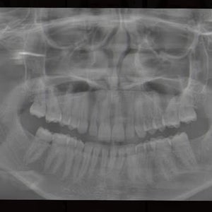 deviated septum xray