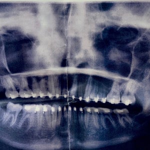 Deviated Septum X Ray