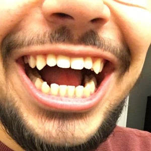 why do i have some sharp teeth