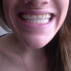 gaps between teeth after invisalign