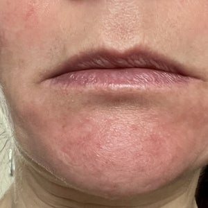 fluorouracil lips
