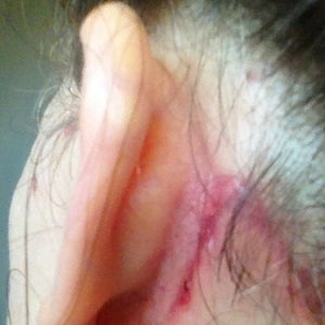 bleeding scar after surgery