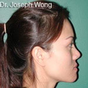 underbite side profile