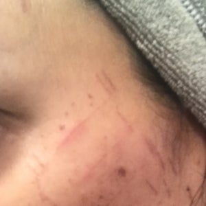 scratch marks on my back