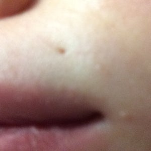 forehead piercing scar