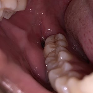 extracted tooth socket black