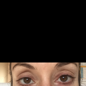 Do Eye Exercises Help Ptosis - Infoupdate.org