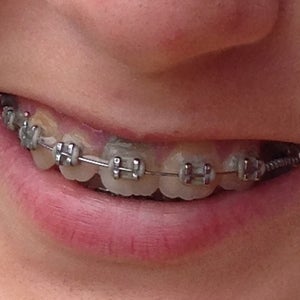 grey braces teeth