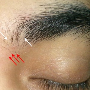 hypothyroidism eyebrows