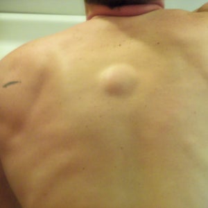 cyst on back