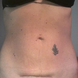 c section scar correction