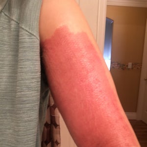 stretch marks on upper arms