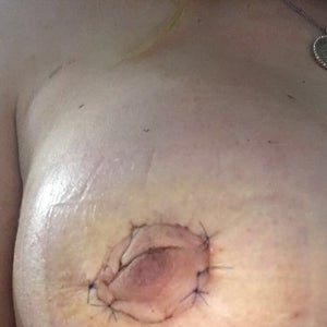 deformed breast after reduction