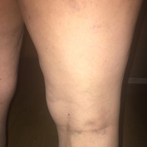 supratrochlear vein bulging