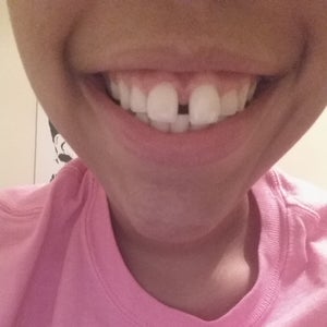wide gap tooth