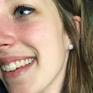 one tooth not tracking