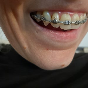 braces black triangle