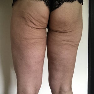 sagging buttocks after 60