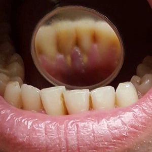 Receding Lower Gums