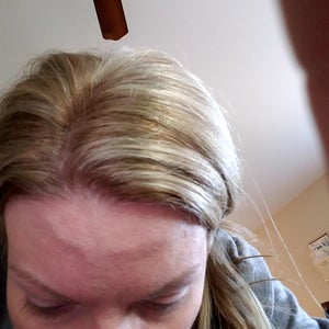 Angry Veins On Forehead