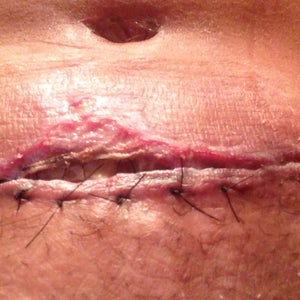 incision wound