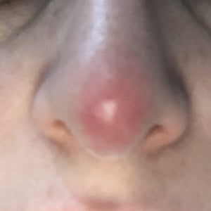 cellulitis nose tip