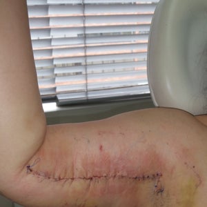 Stitches In Arm How Long