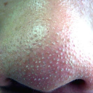 Trichostasis Spinulosa Causes
