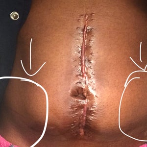 laparotomy scars