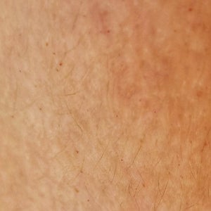pinpoint red dots on skin treatment