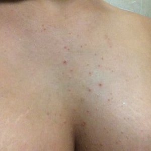 pimples on chest