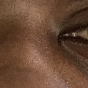 birthmark behind eye