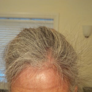 Telogen effluvium regrowth store